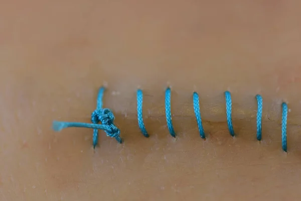 Skin stitches Stock Photos, Royalty Free Skin stitches Images ...