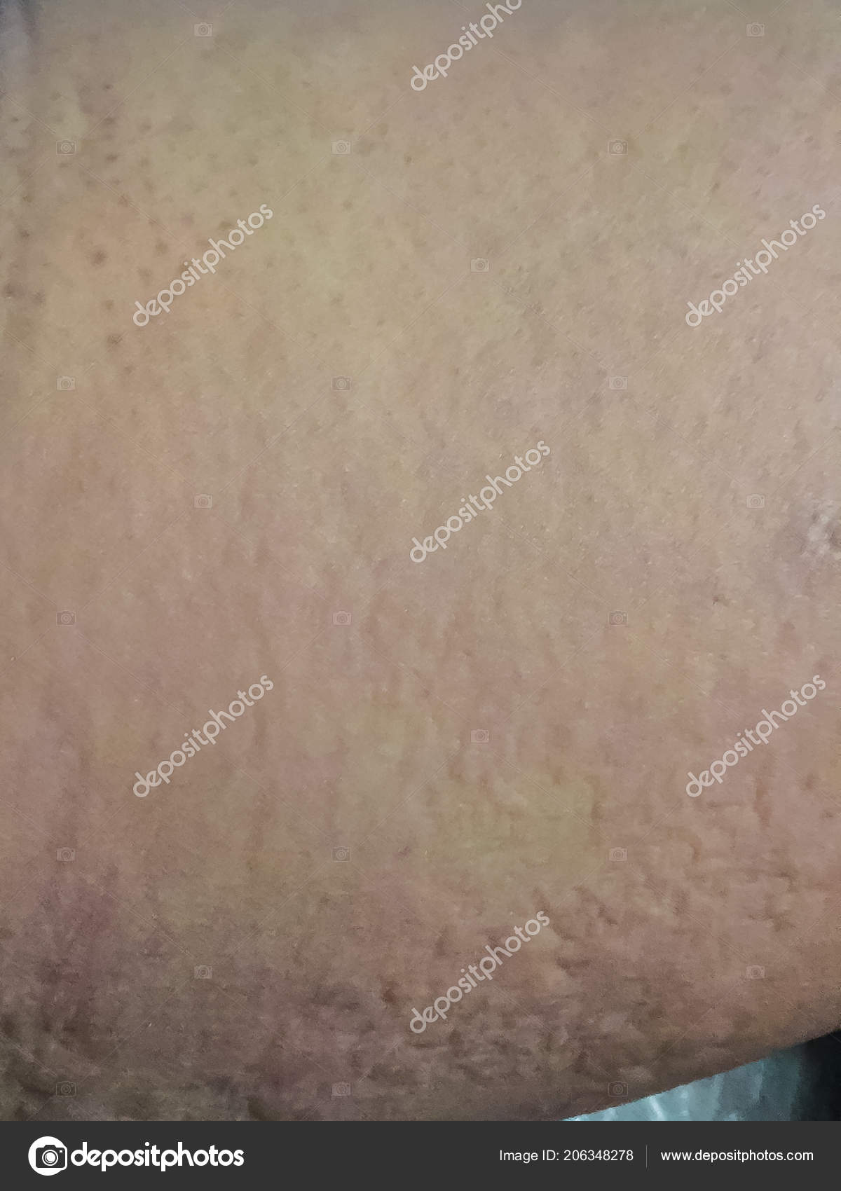 Close View Cold Urticaria Allergic Rash Symptoms Itchy Urticaria ...