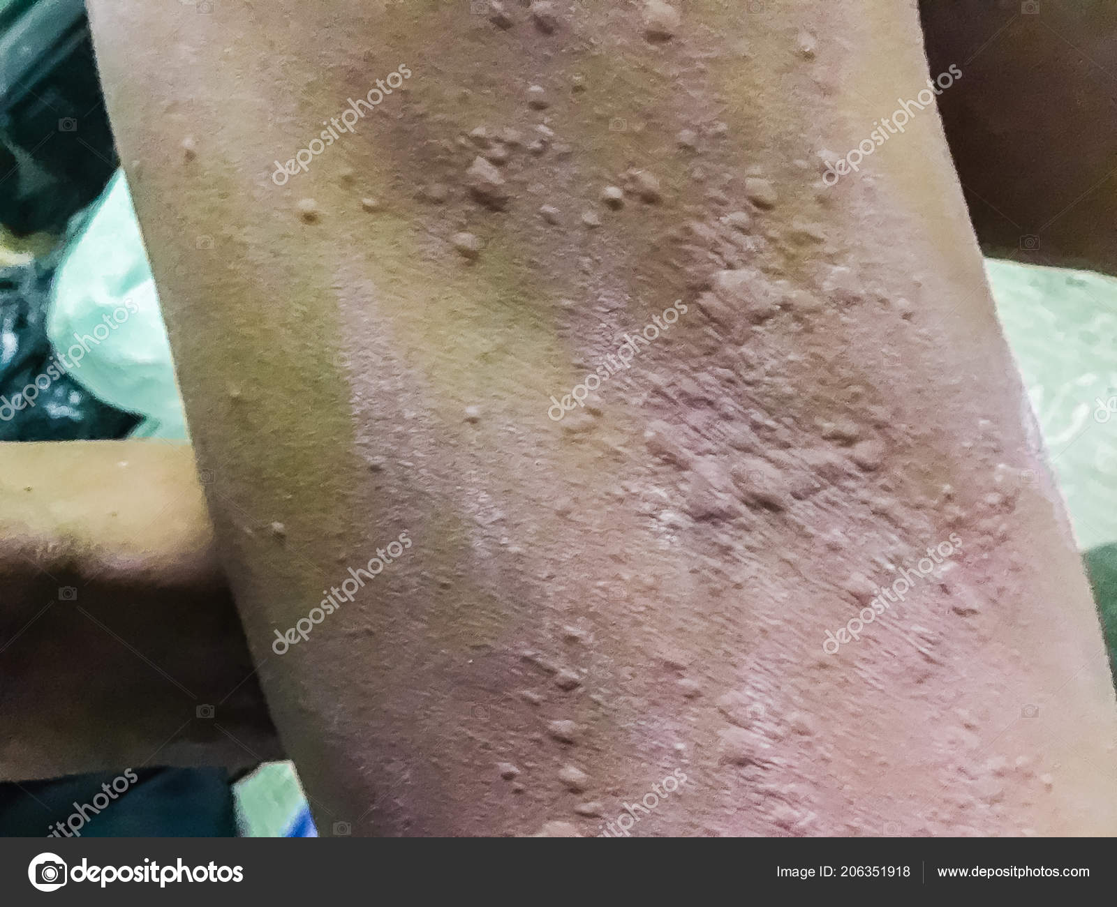 Close View Cold Urticaria Allergic Rash Symptoms Itchy Urticaria ...