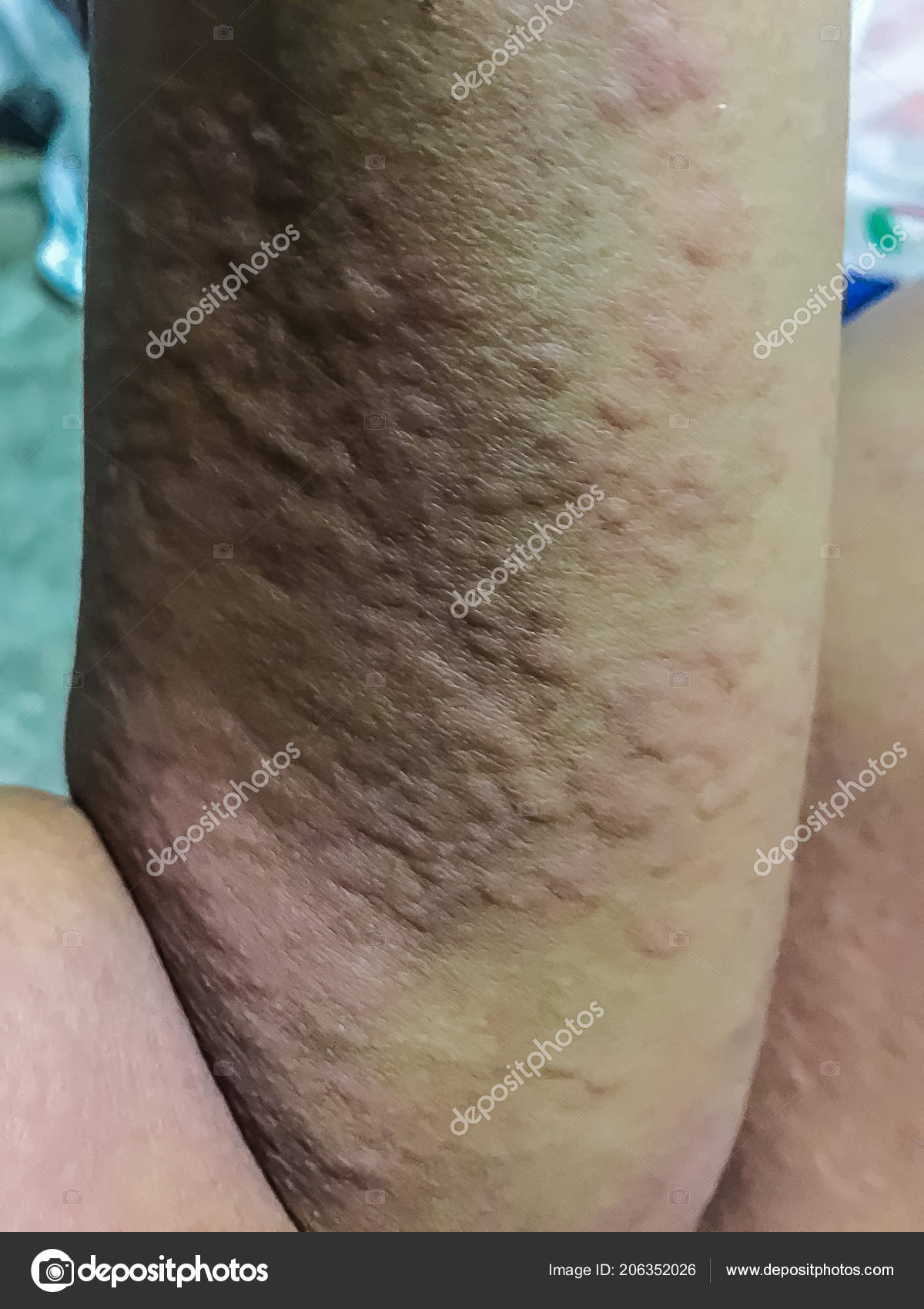 Cold Urticaria Legs