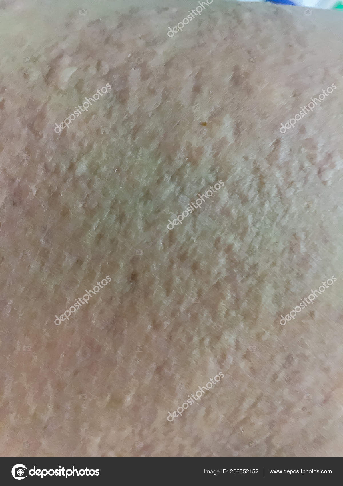 Close View Cold Urticaria Allergic Rash Symptoms Itchy Urticaria ...