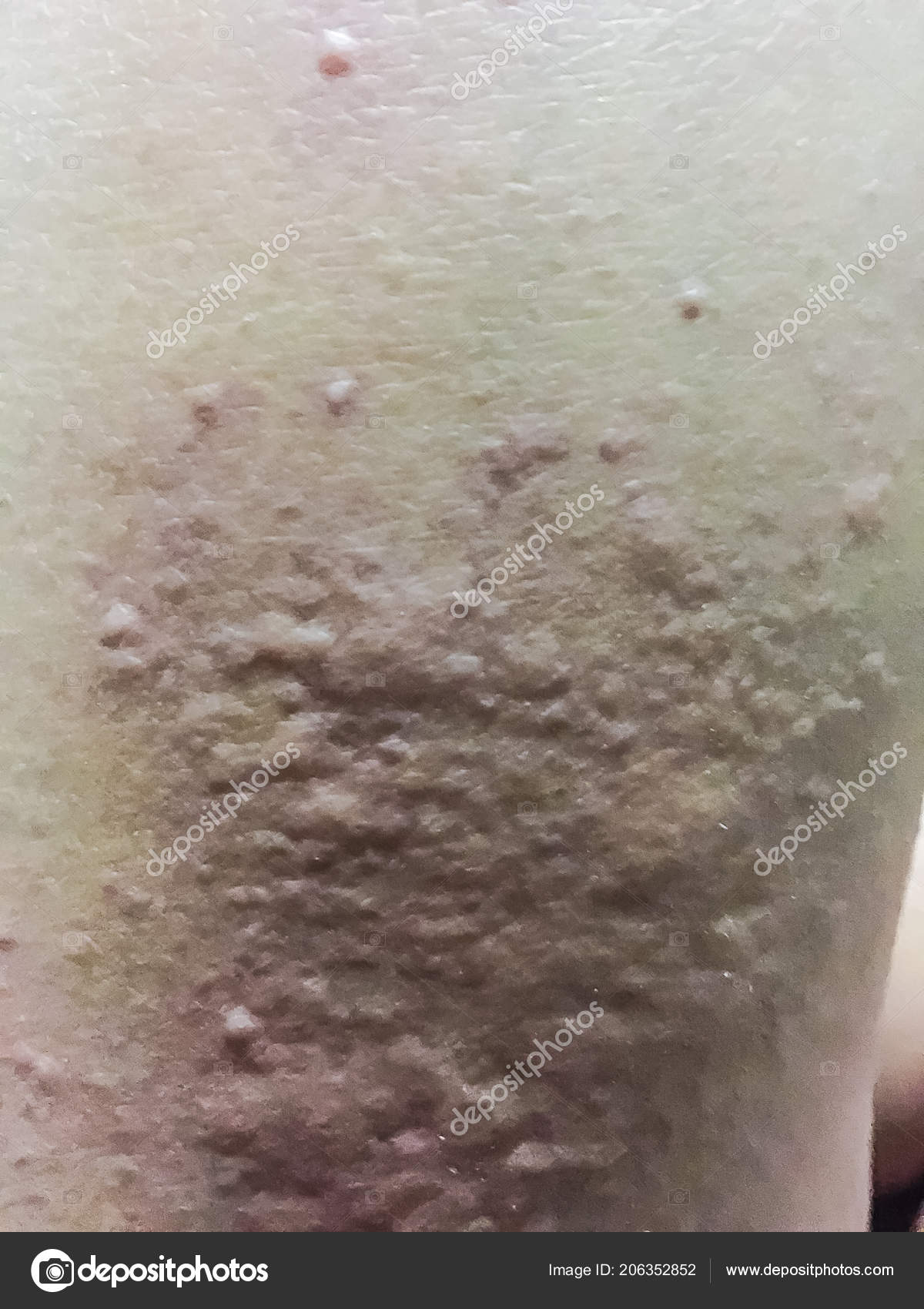 Close View Cold Urticaria Allergic Rash Symptoms Itchy Urticaria ...