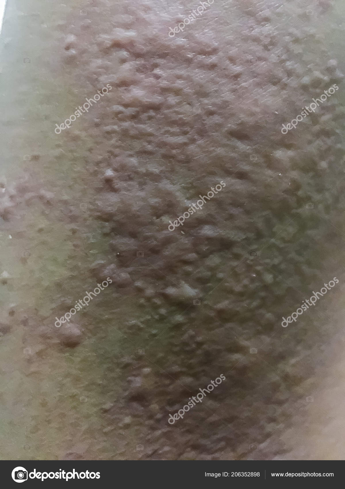 Close View Cold Urticaria Allergic Rash Symptoms Itchy Urticaria ...