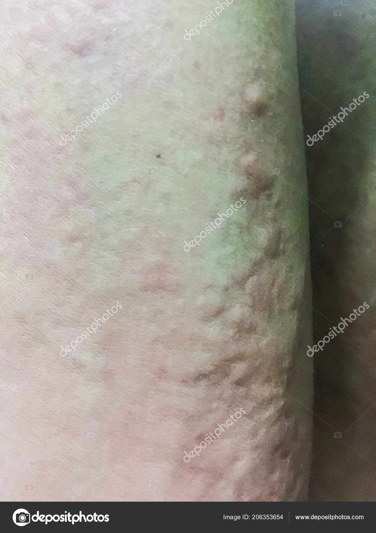 Cold Urticaria