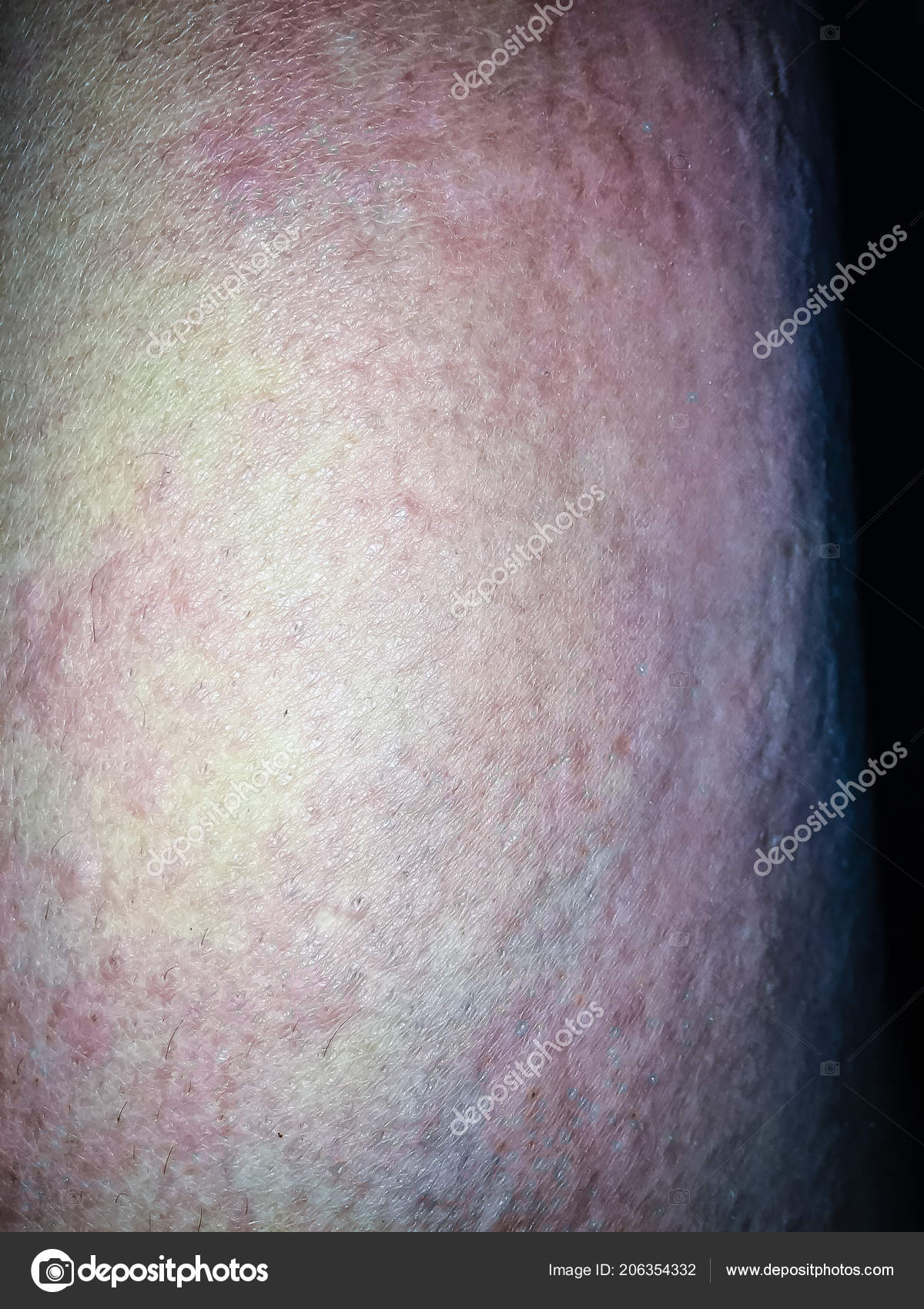 Close View Cold Urticaria Allergic Rash Symptoms Itchy Urticaria Stock ...