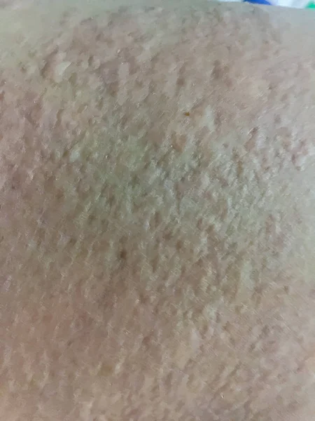 Cold urticaria Pictures, Cold urticaria Stock Photos & Images ...