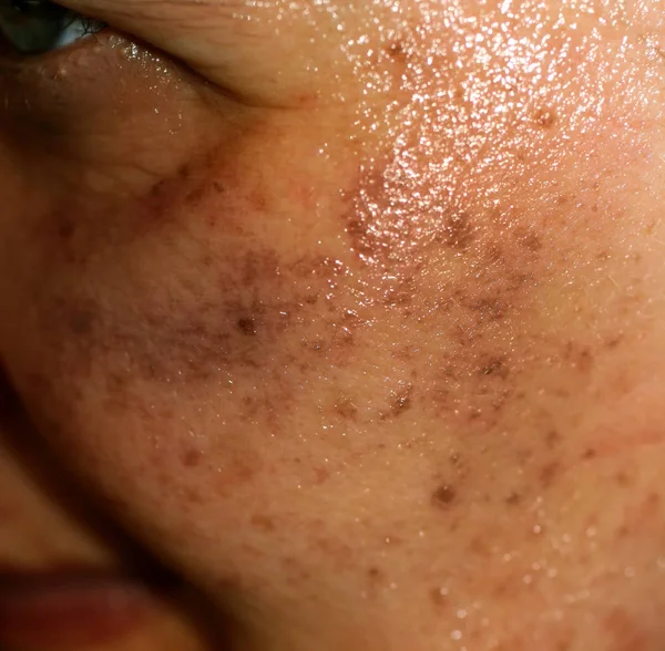 Pigmented spots on the face. Pigmentation on cheeks - Stock Image ...