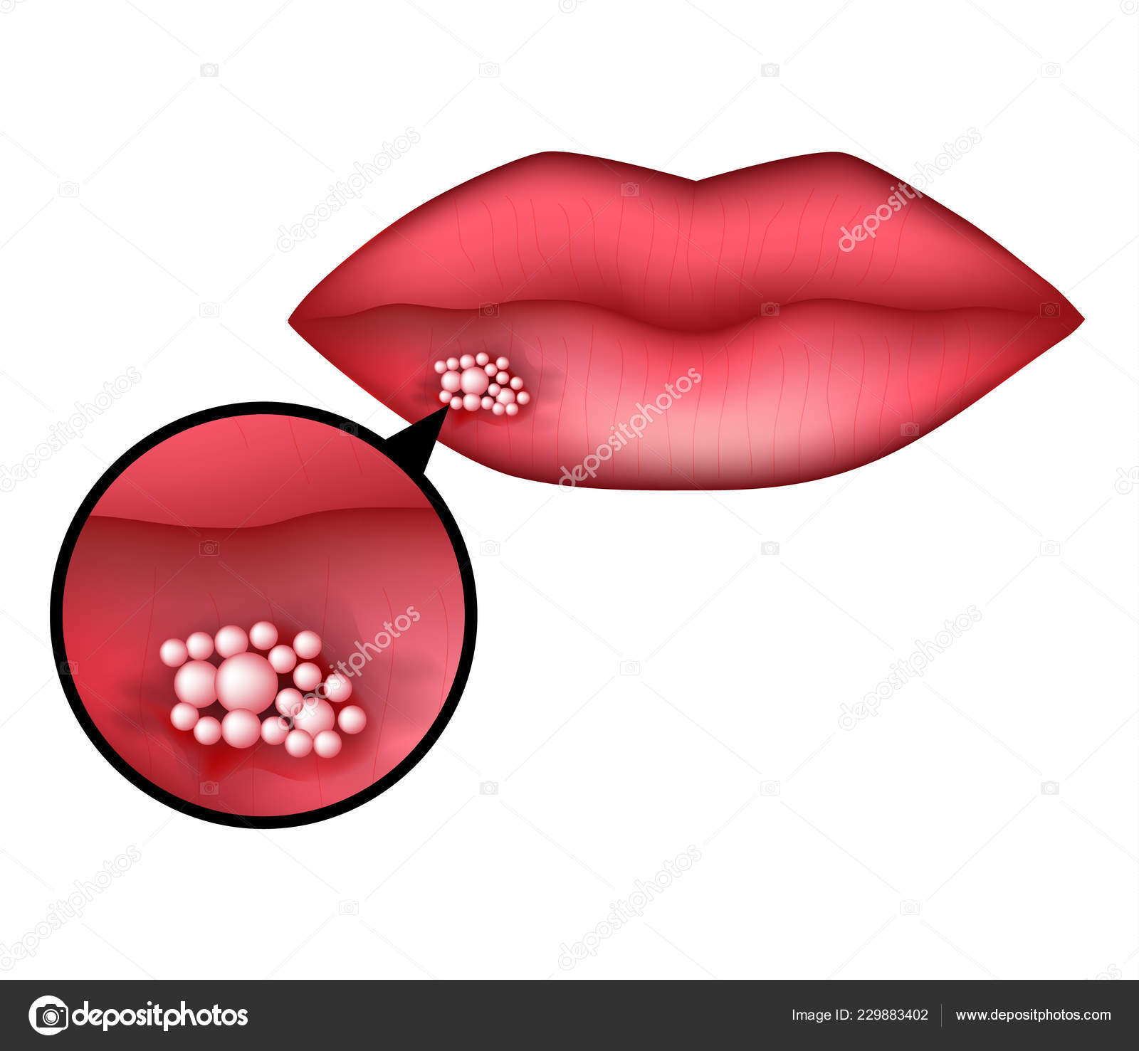 Herpes Lip Infographics Vector Illustration Isolated Background Stock ...