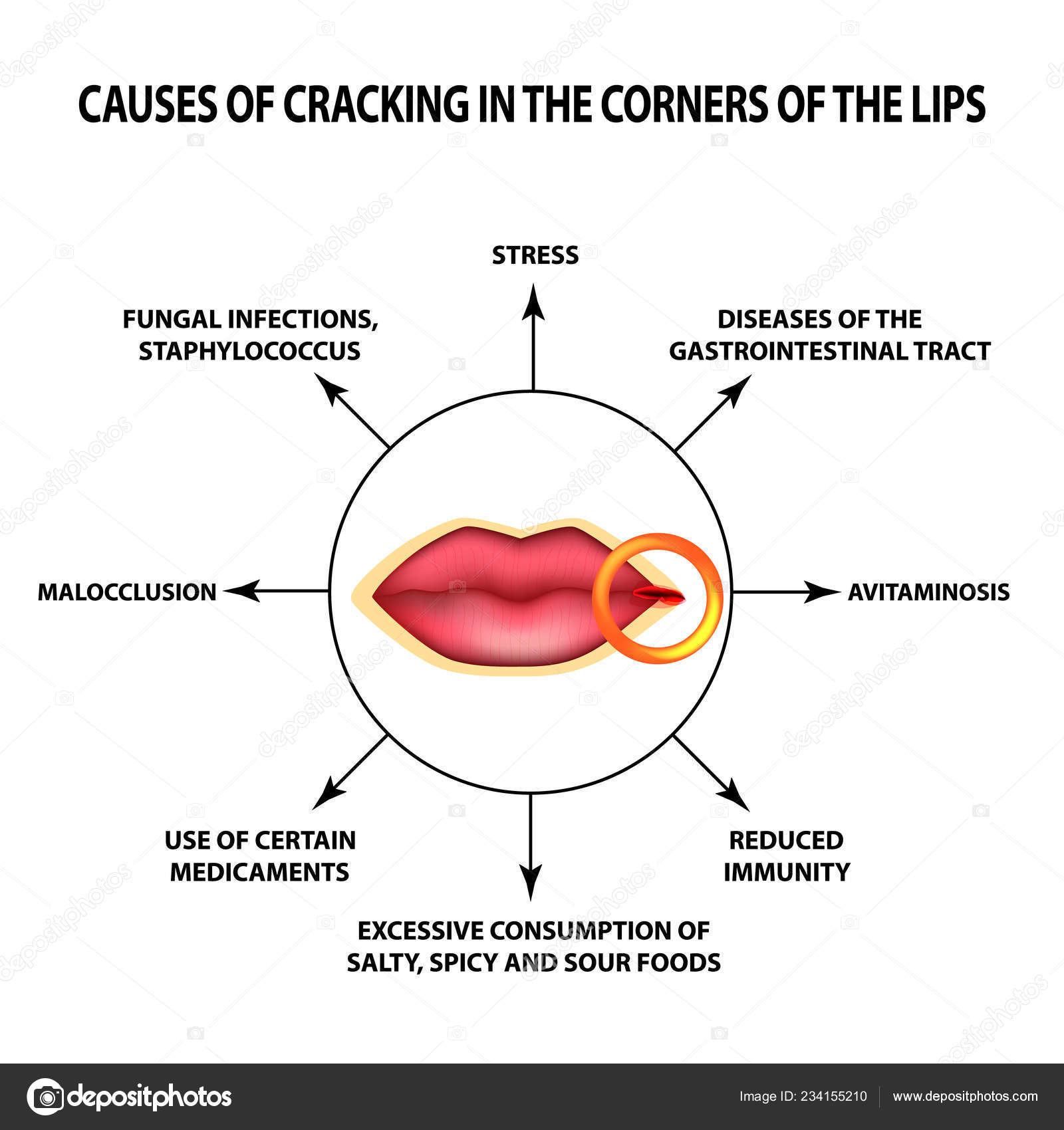 Cracked Lips Corners