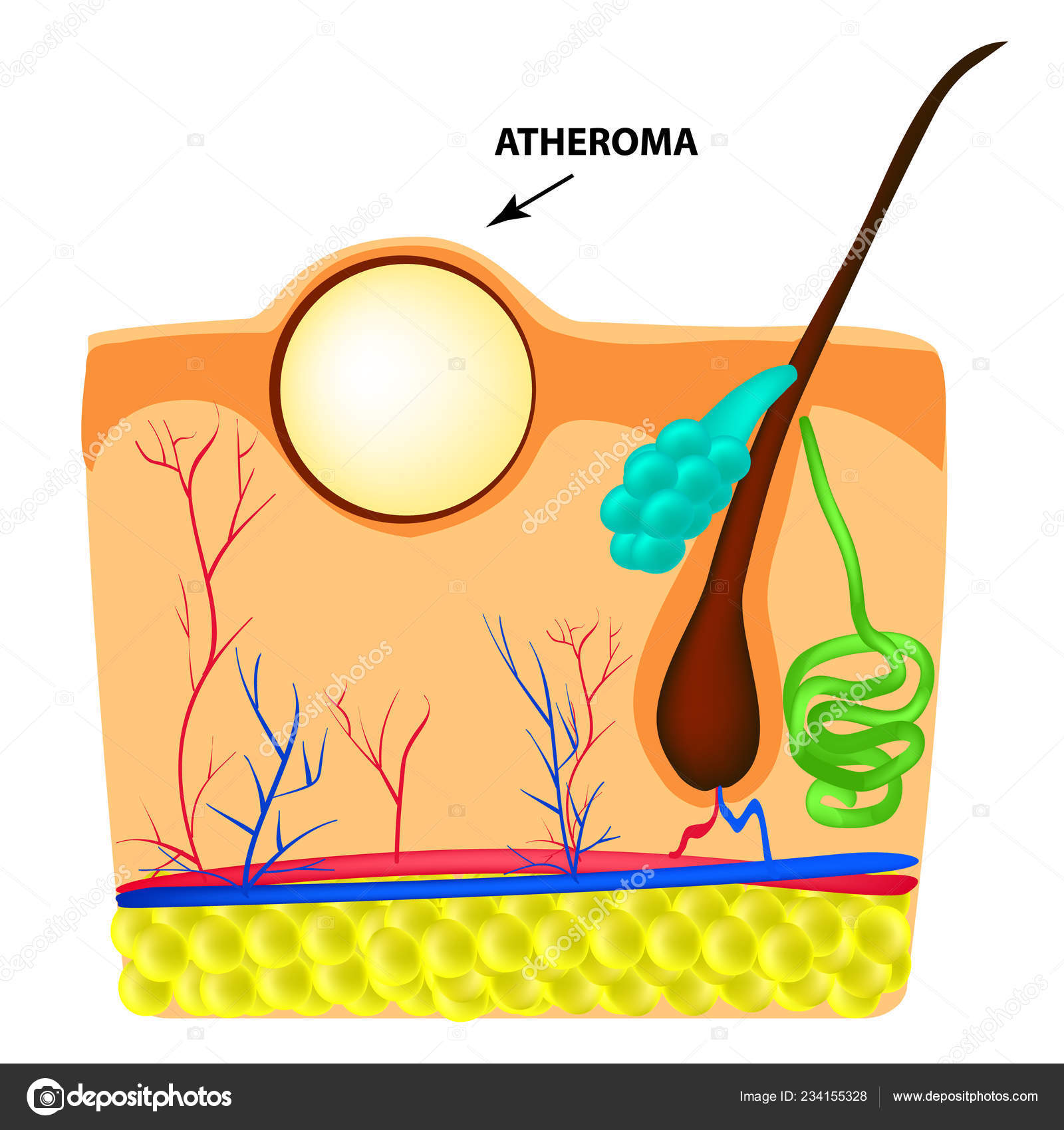 Atheroma Structure Structure Moles Skin Infographics Vector ...