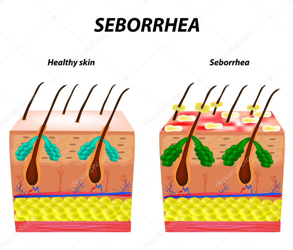 Seborrea piel y cabello. Dermatitis seborreica por caspa. Eccema ...