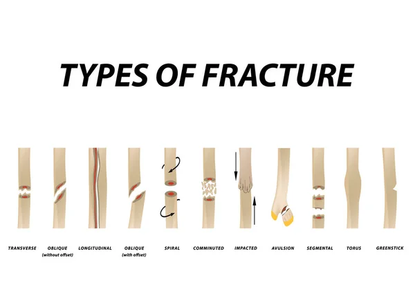 Stages Healing Bone Fracture Formation Callus Bone Fracture Infographics Vector Stock Vector by ...