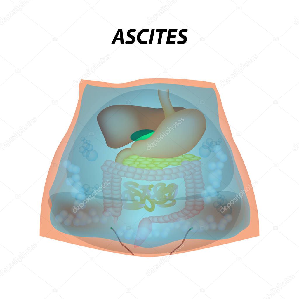 Ascitis líquido libre en la cavidad abdominal. Infografías. Ilustración ...
