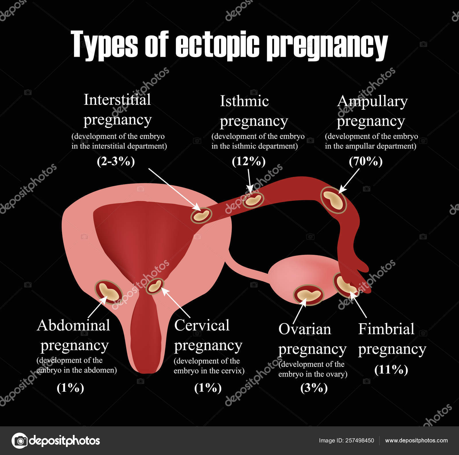 Types Of Uterine Fibroids Endometriosis Infographics Vector