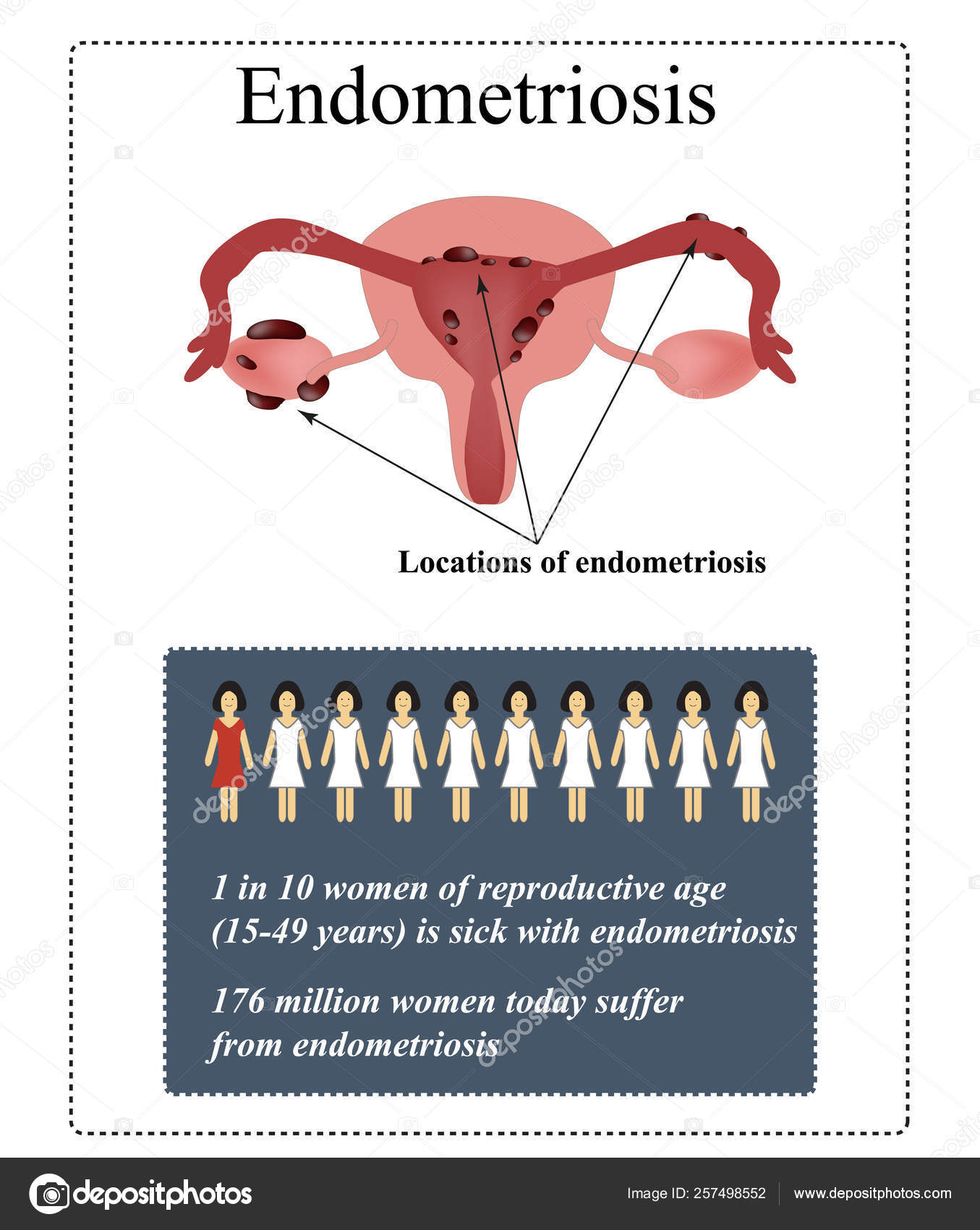 Endometriosis. Endometrial cysts. Vector illustration on isolated Stock ...