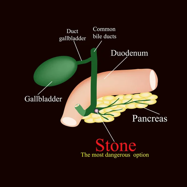 Stone pancreatic bile duct. The gall bladder, duodenum, bile ducts ...