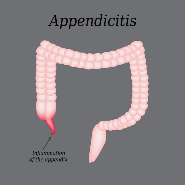 Appendicitis. Inflammation of the appendix. Colon. The illustration on ...