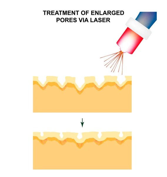Treatment of caries. Sealing of the tooth. Infographics. Vector ...