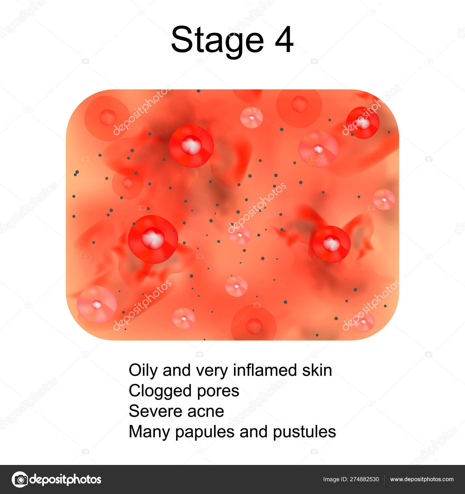 Stage 4 of development of acne. Inflamed skin with scars, acne and ...