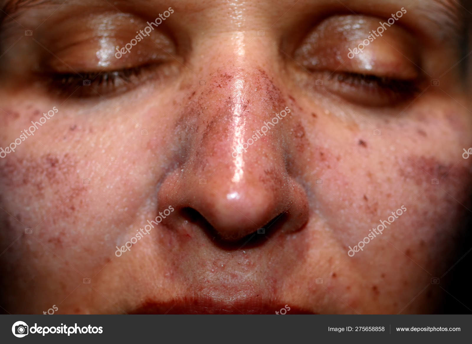 Taches pigmentées sur le visage. Pigmentation sur les joues image libre ...