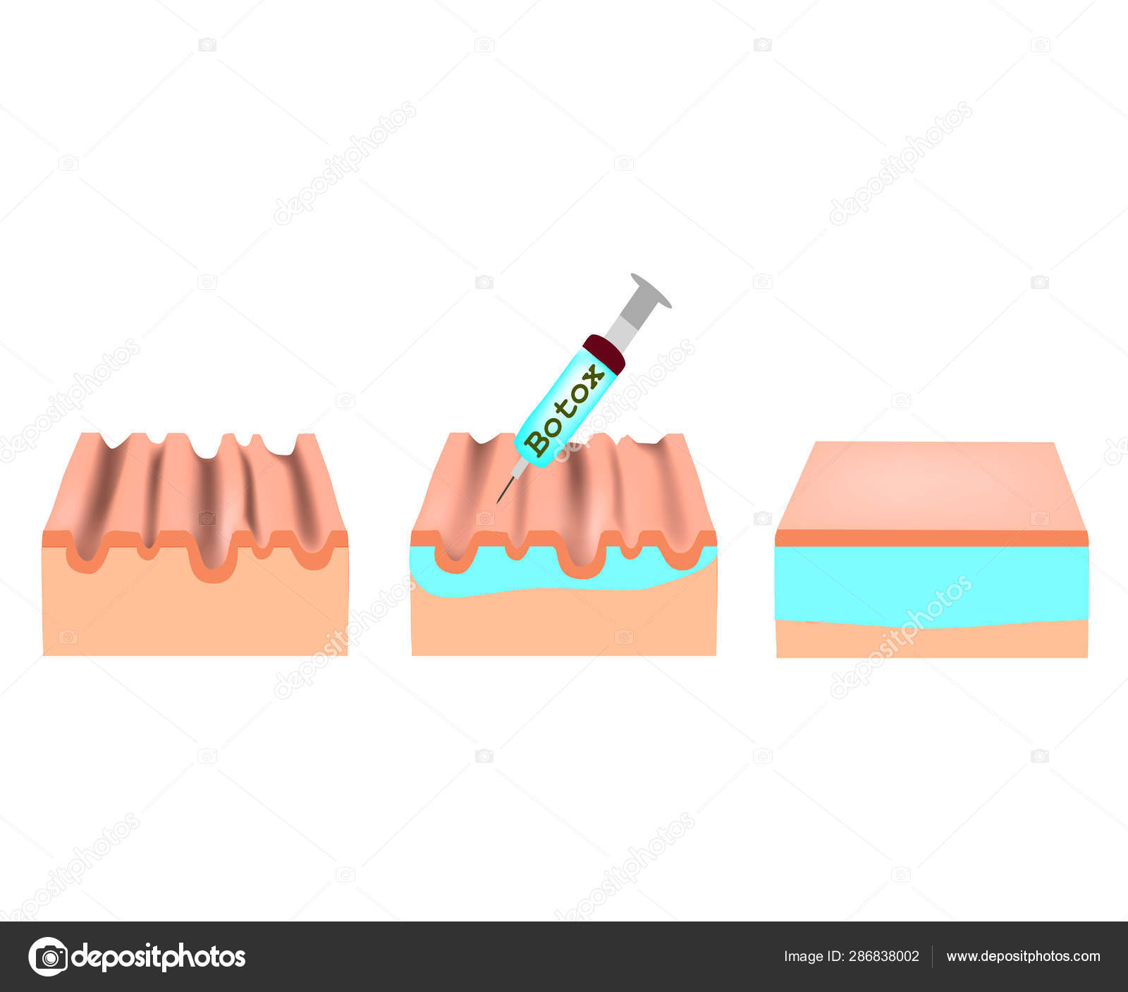 Wrinkles on the skin. Botox wrinkle treatment. Anatomical skin ...