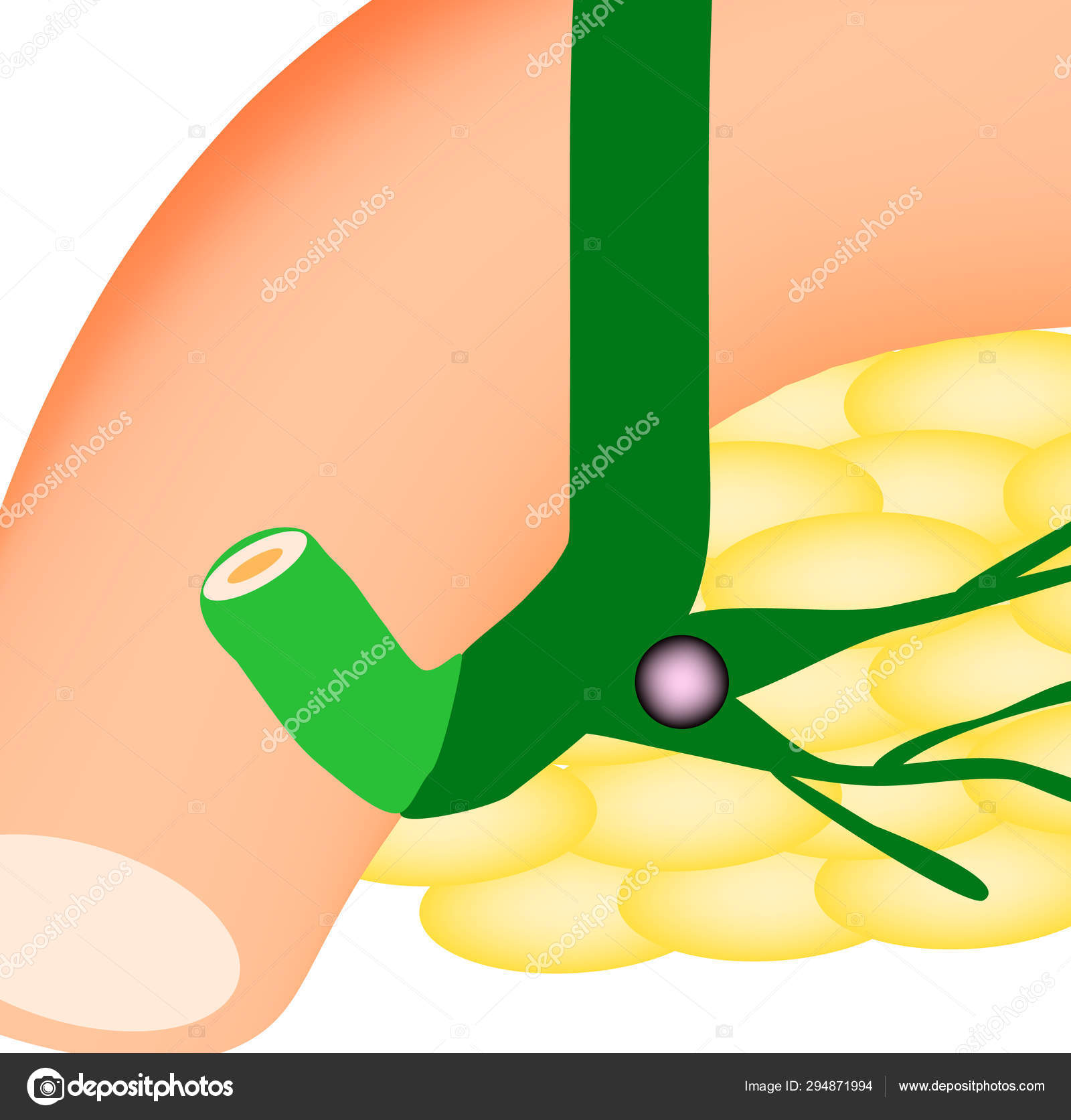 Kivinen haiman sappitie. Vaarallisin kivi. Sappirakko, pohjukaissuoli ...