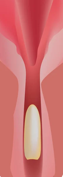 Typer av fistlar i ändtarmen. Paraproctitis. Anus. Abscess i ändtarmen ...