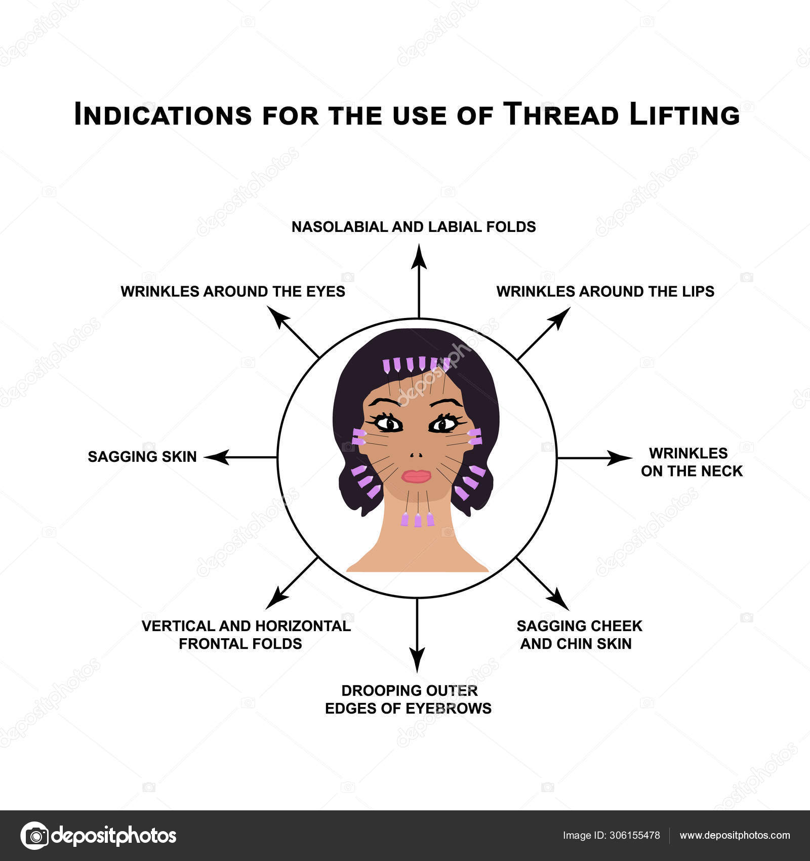 Indications for the use of thread lifting. Mesotherapy Wrinkles ...