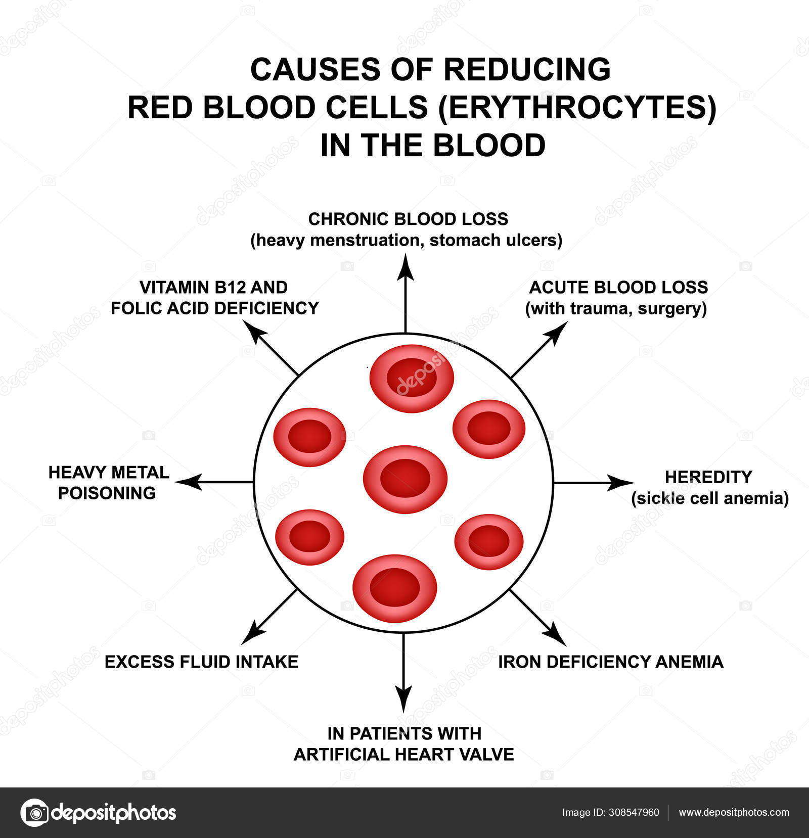 Causes de la réduction des globules rouges. Cellules érythrocytes. L ...