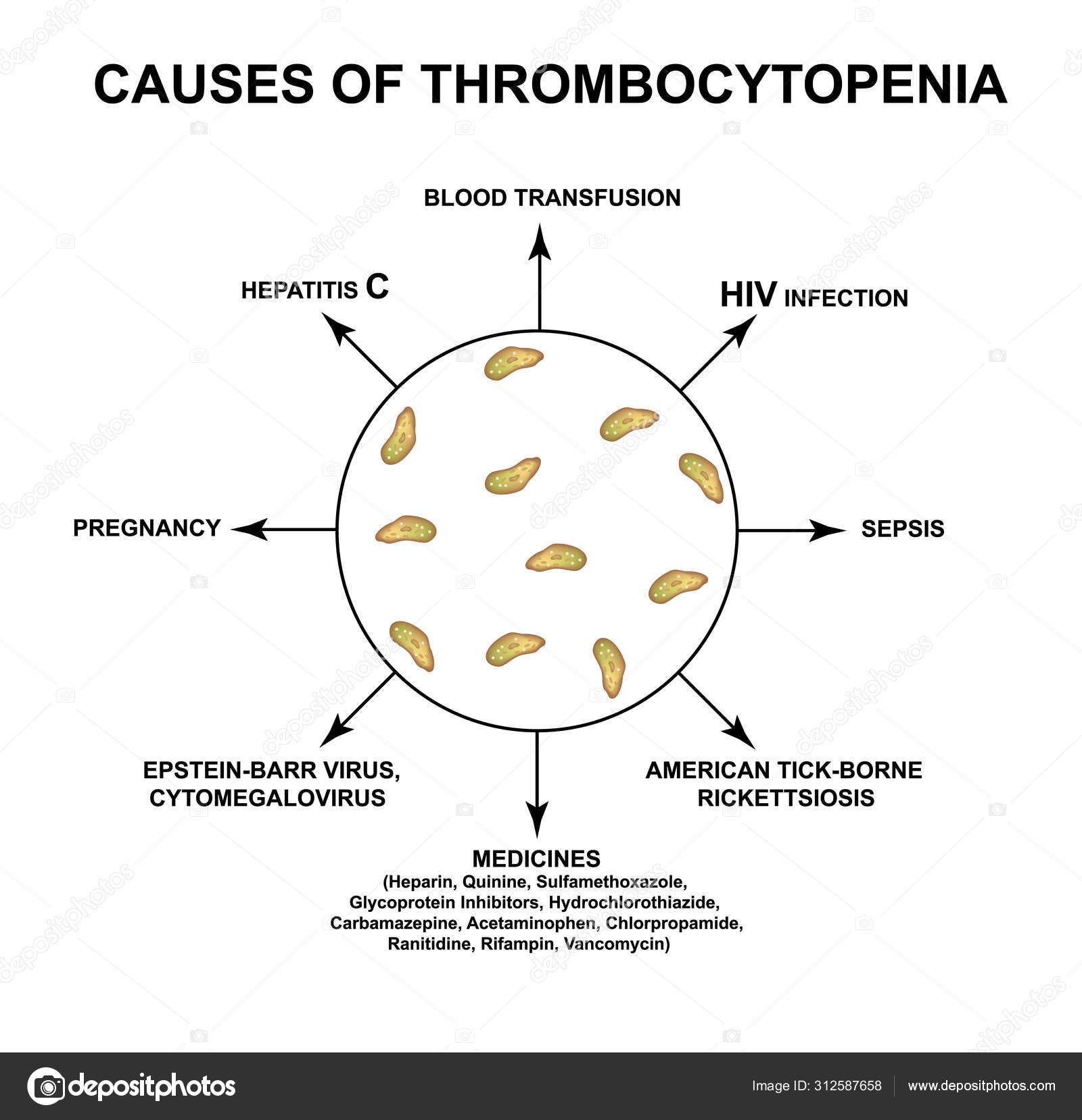 Causes de thrombopénie. Réduire les plaquettes dans le sang ...