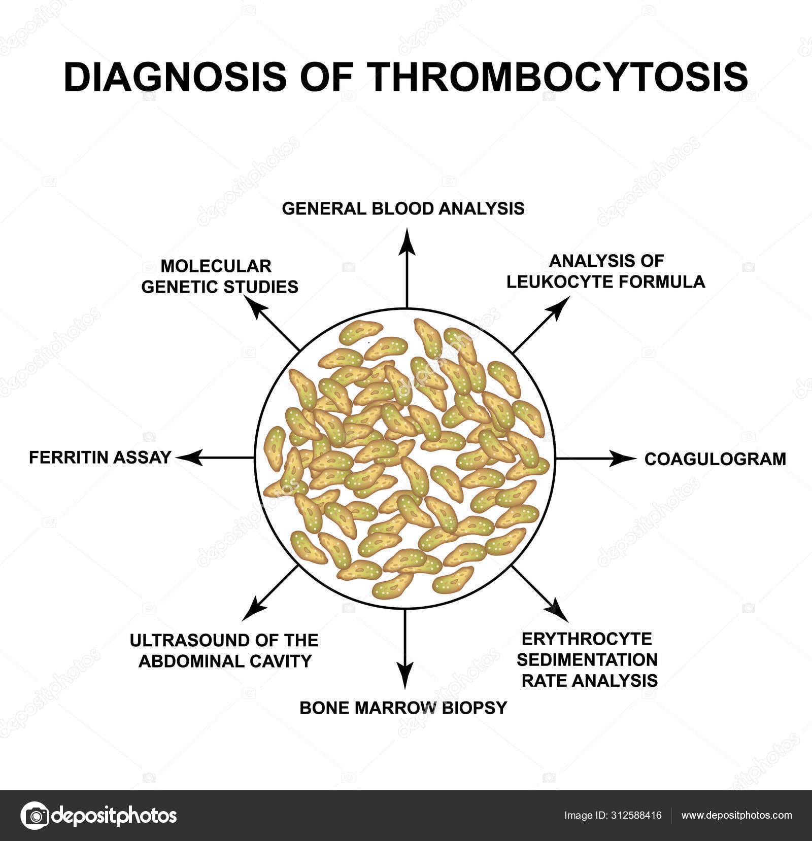Diagnosis of thrombocytosis. An increase in platelets in the blood ...