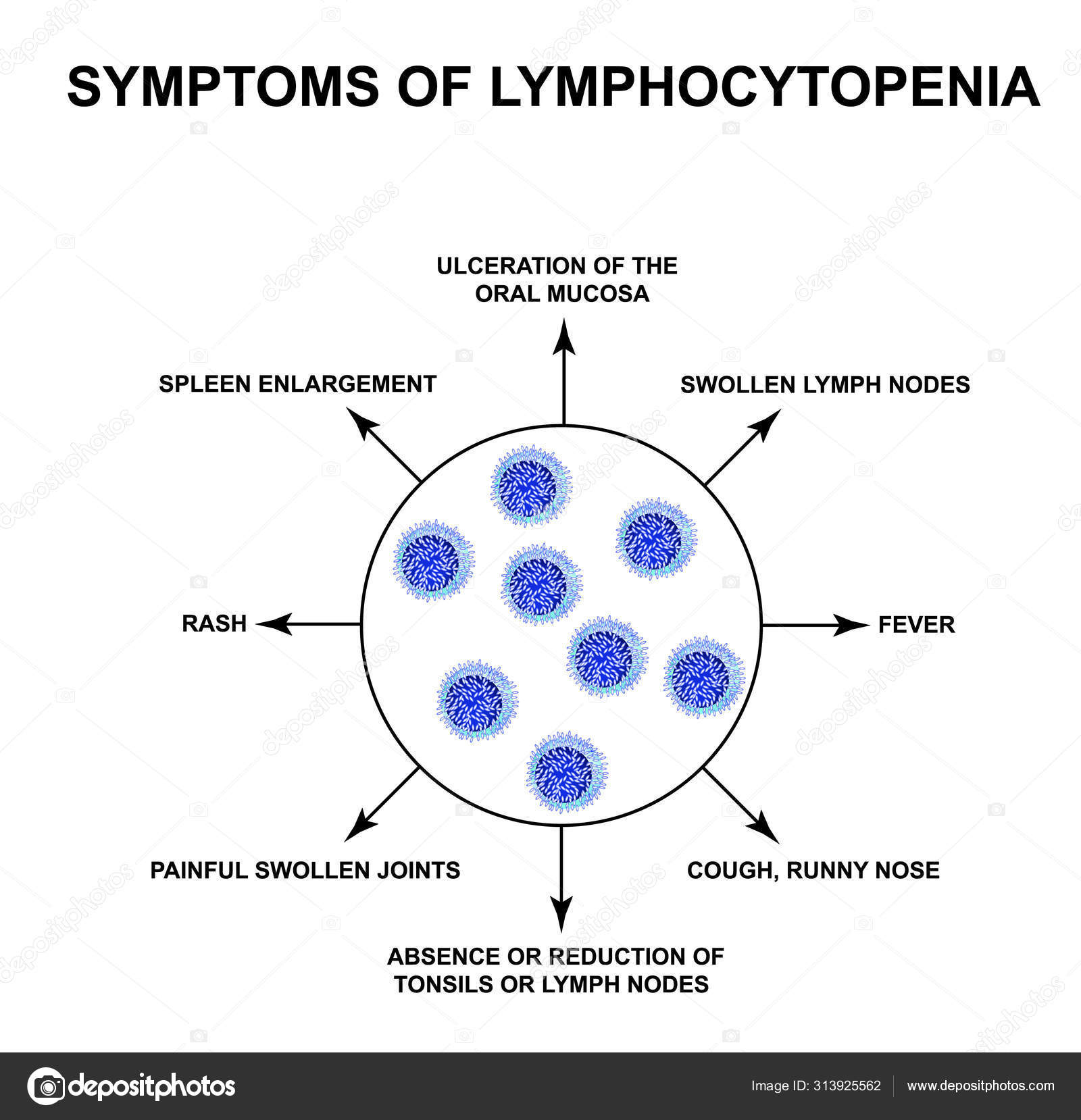 Symptoms of lymphocytopenia. Decreased lymphocytes in the blood ...