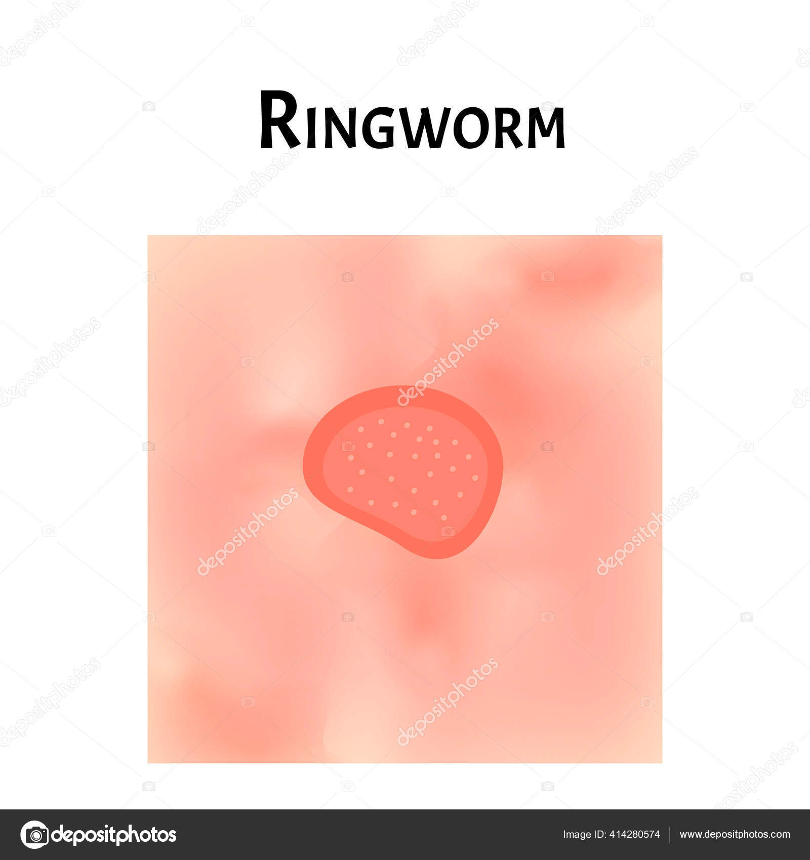 Ringworm on the skin. Vector illustration on isolated background Stock ...