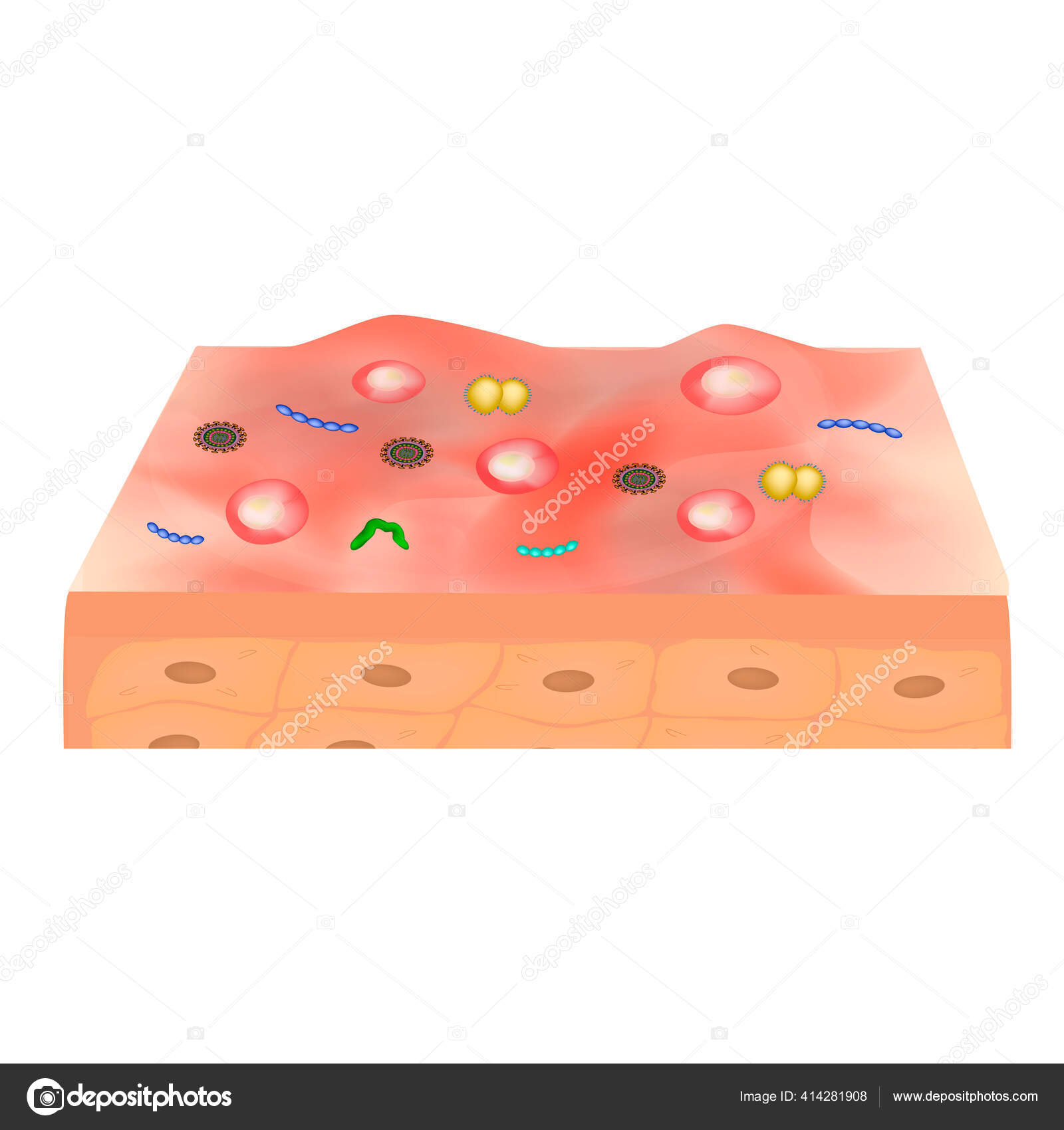 Piel inflamada con bacterias. Enfermedades infecciosas de la piel ...