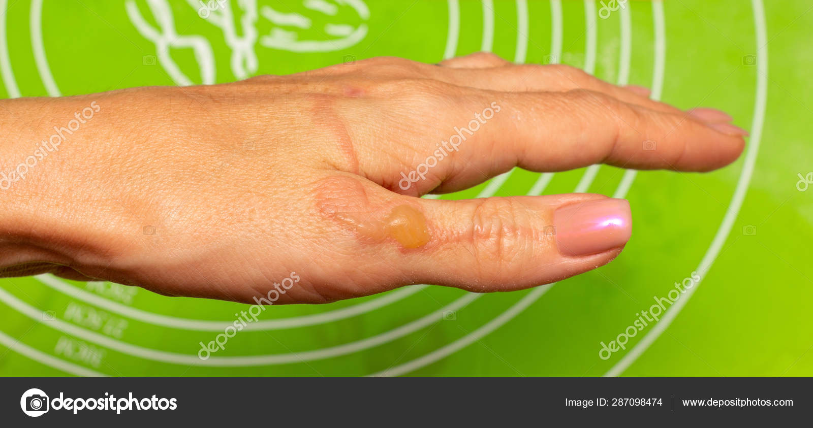 1st Degree Burn Blister