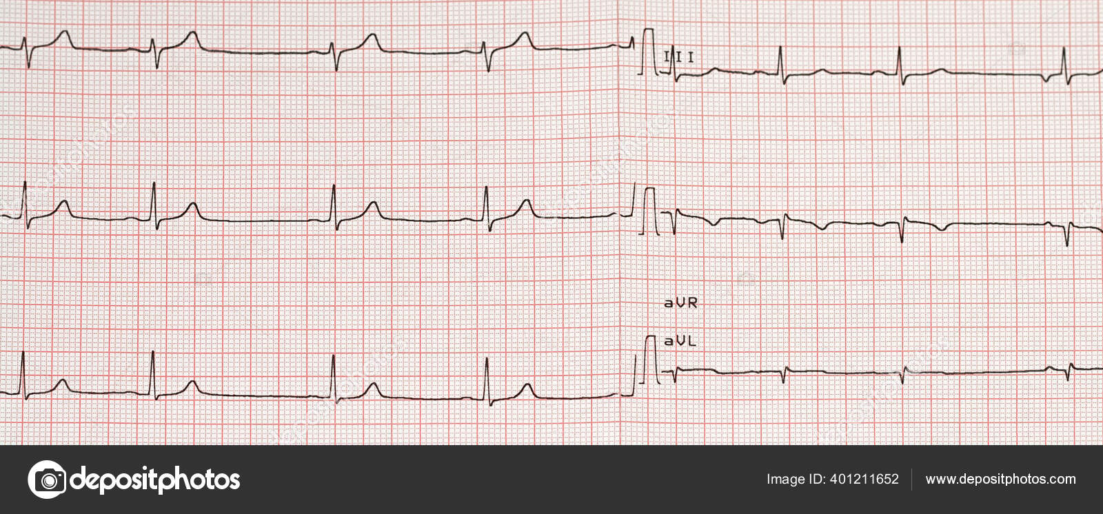 Exemplo Eletrocardiograma Ritmo Sinusal Normal Derivações — Foto ...