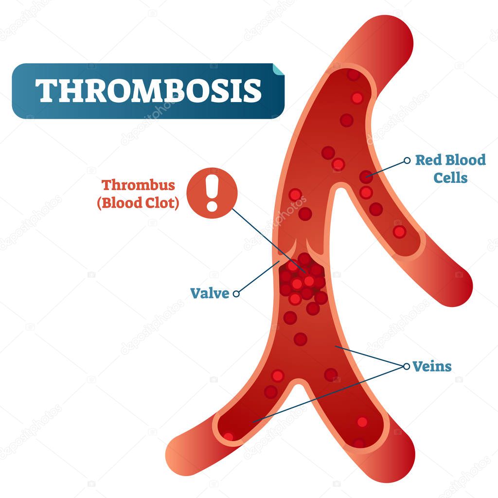 Trombosis vector médico ilustración diagrama de sección transversal ...
