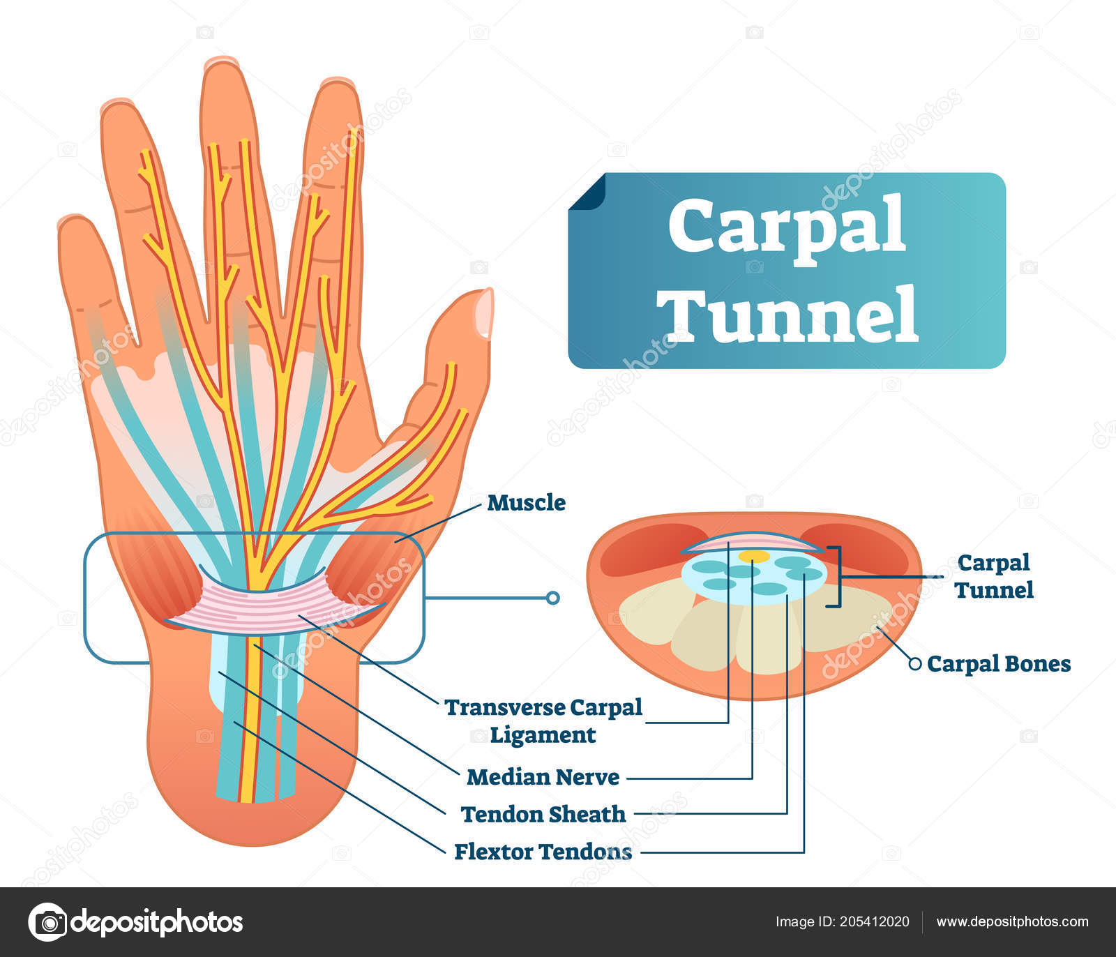 Carpal tunnel vector illustration scheme. Medical labeled diagram ... Carpal tunnel vector illustration scheme. Medical labeled diagram ...