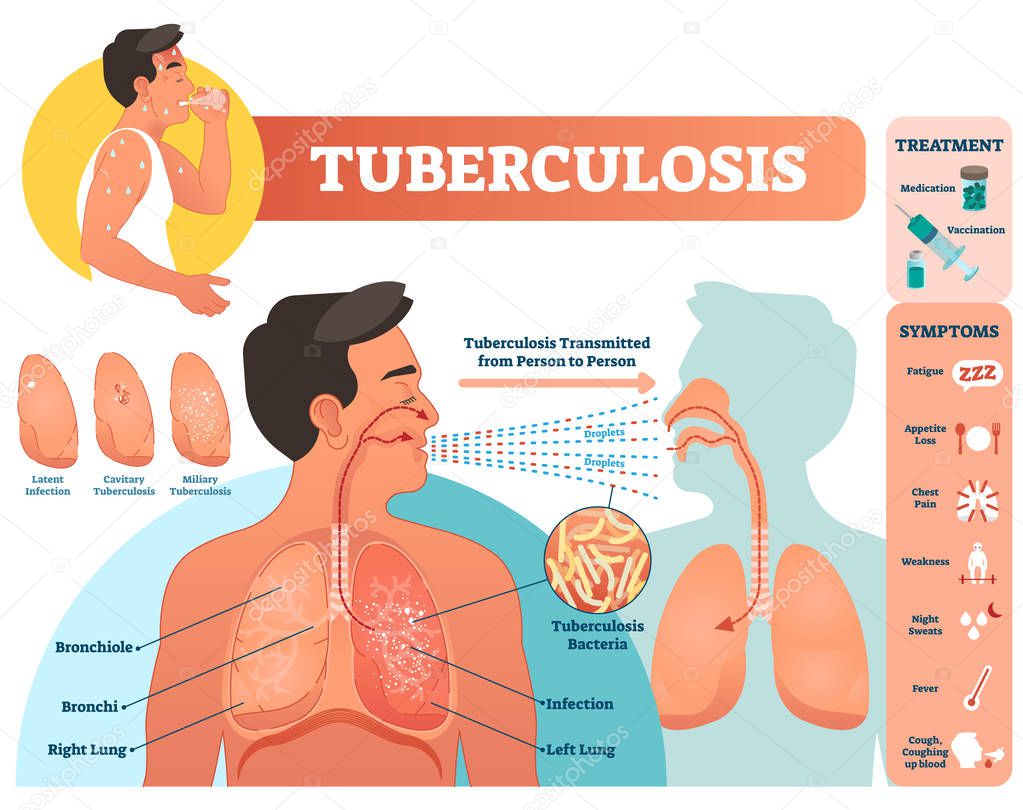 Ilustración vectorial de tuberculosis. Síntomas detallados y esquema de tratamiento. 2023