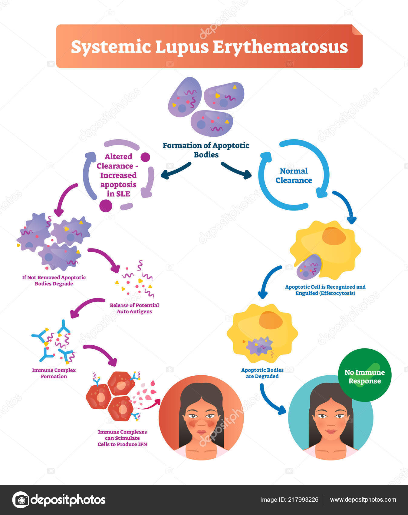 Systemic lupus erythematosus labeled diagram with normal and sick ... Systemic lupus erythematosus labeled diagram with normal and sick ...