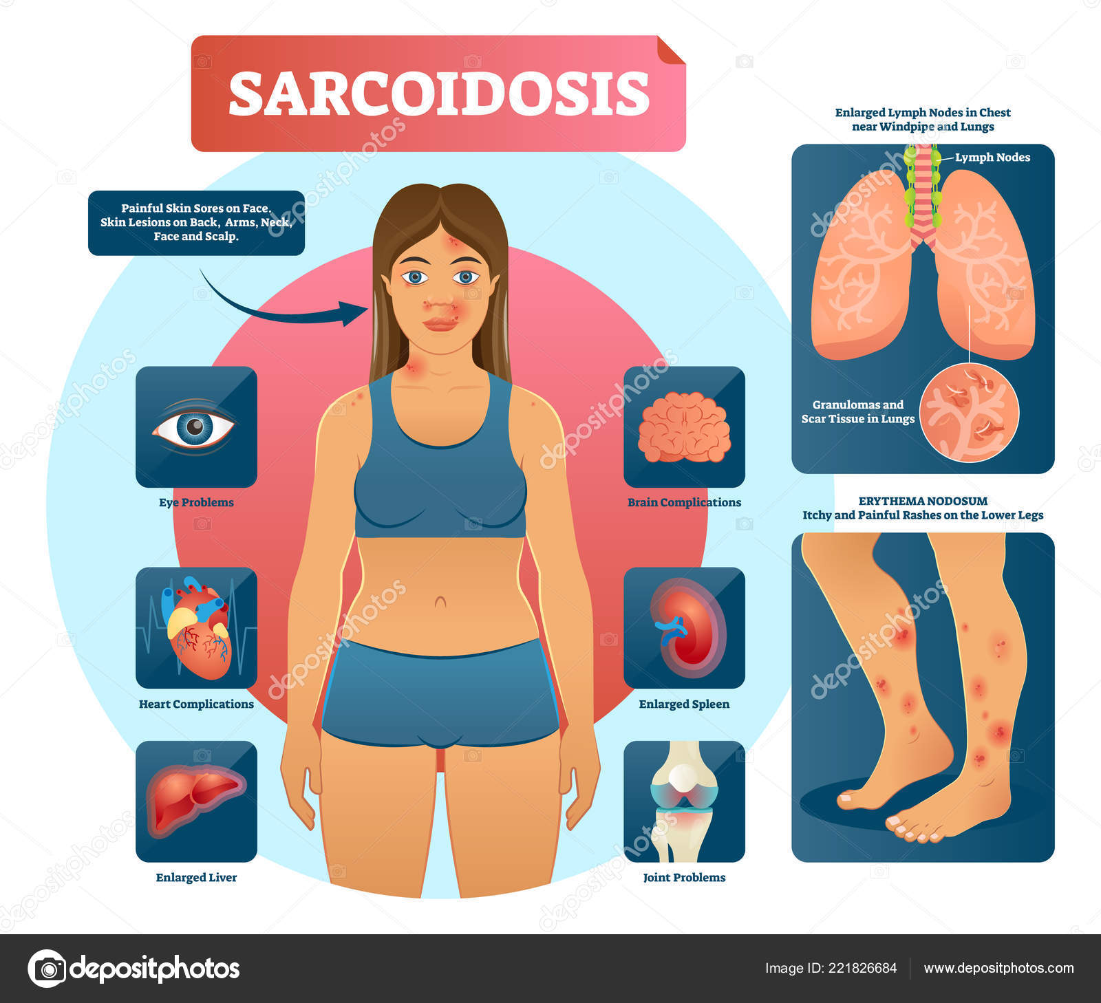 Sarcoidosis Vector Illustration Lungs Heart Eyes Autoimmune Disease Stock Vector Image By
