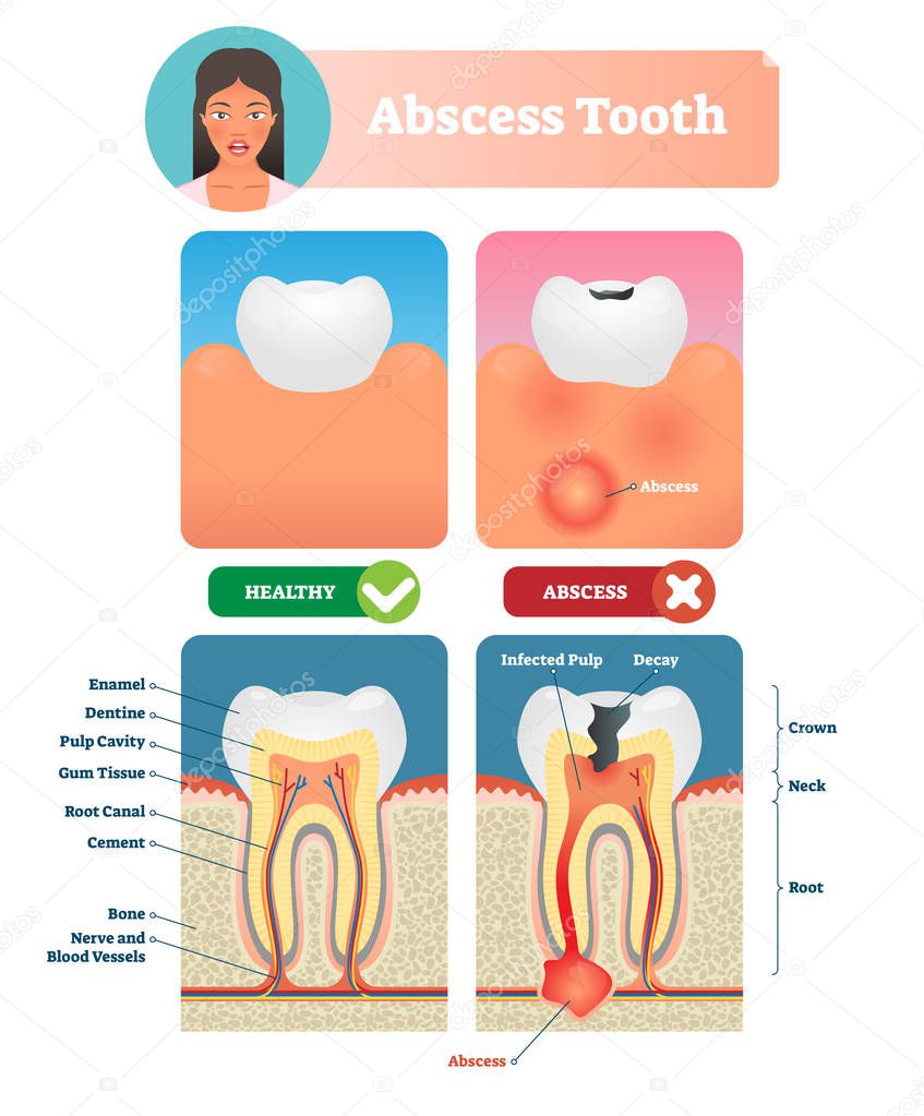 Ilustración de vectores dentales abscesos. Diagrama médico etiquetado ...