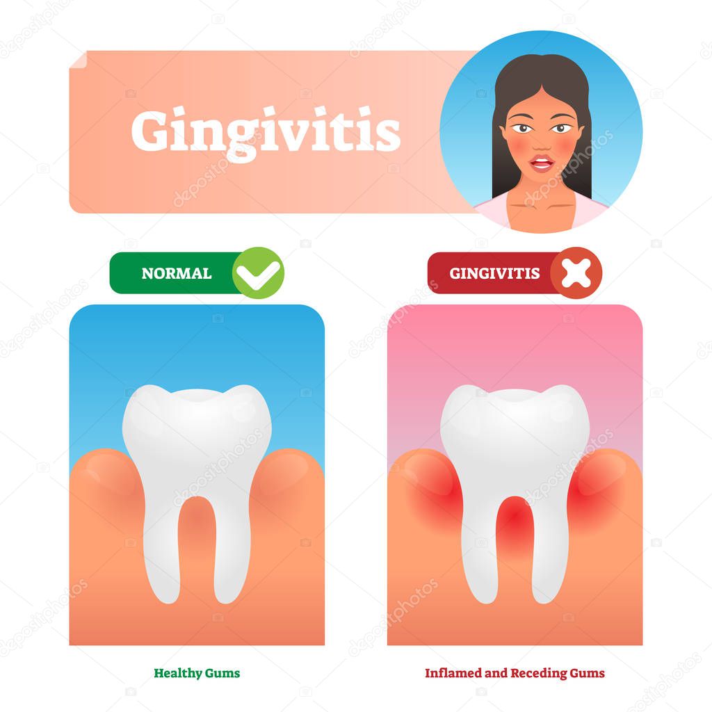 Gingivitis vector ilustración. Enfermedad bucal médica ejemplo de ...