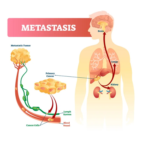 Ilustración vectorial de metástasis. Cáncer primario y diagrama etiquetado del tumor. 2024