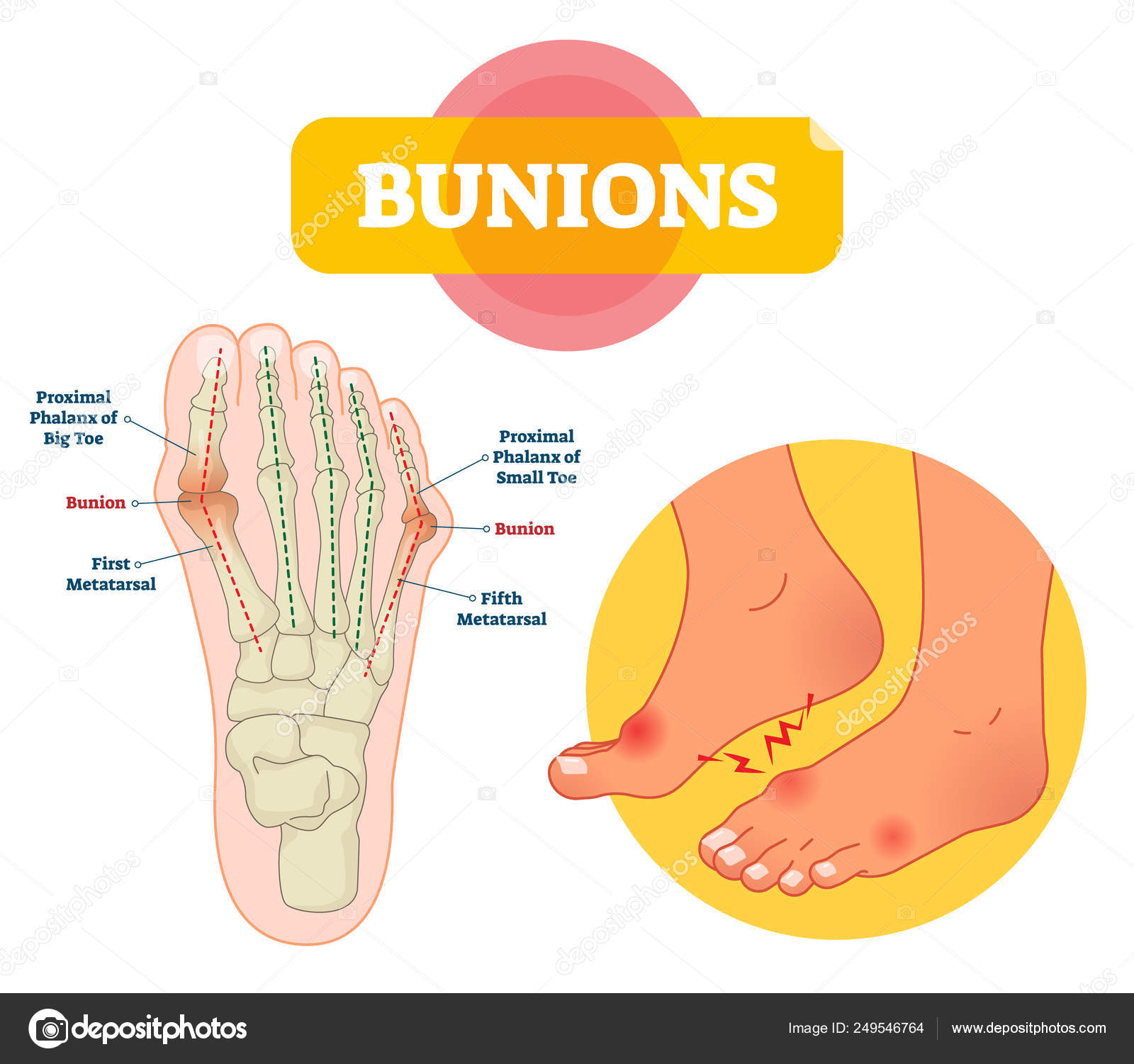 Bunions vector illustration. Labeled feet bone disorder explanation ...