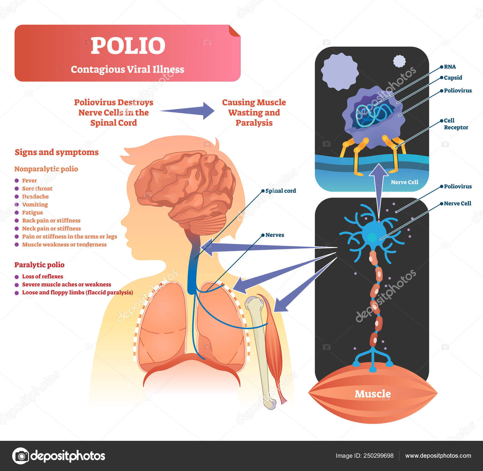 Polio vector illustration. Labeled medical virus infection symptoms ...