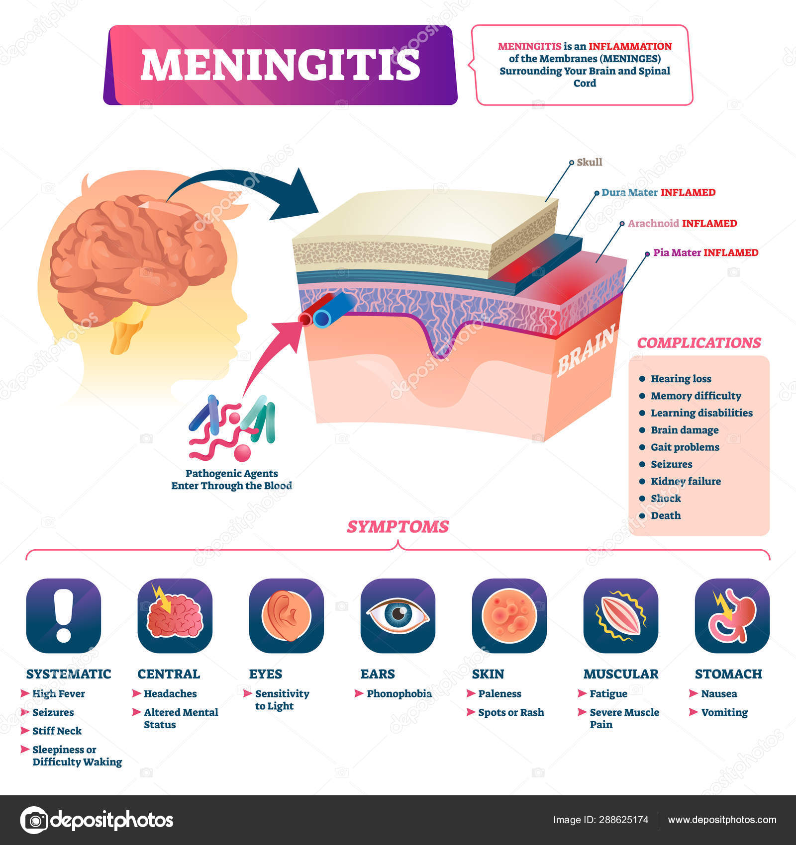Meningitis vector illustration. Labeled brain membrane inflammation ...