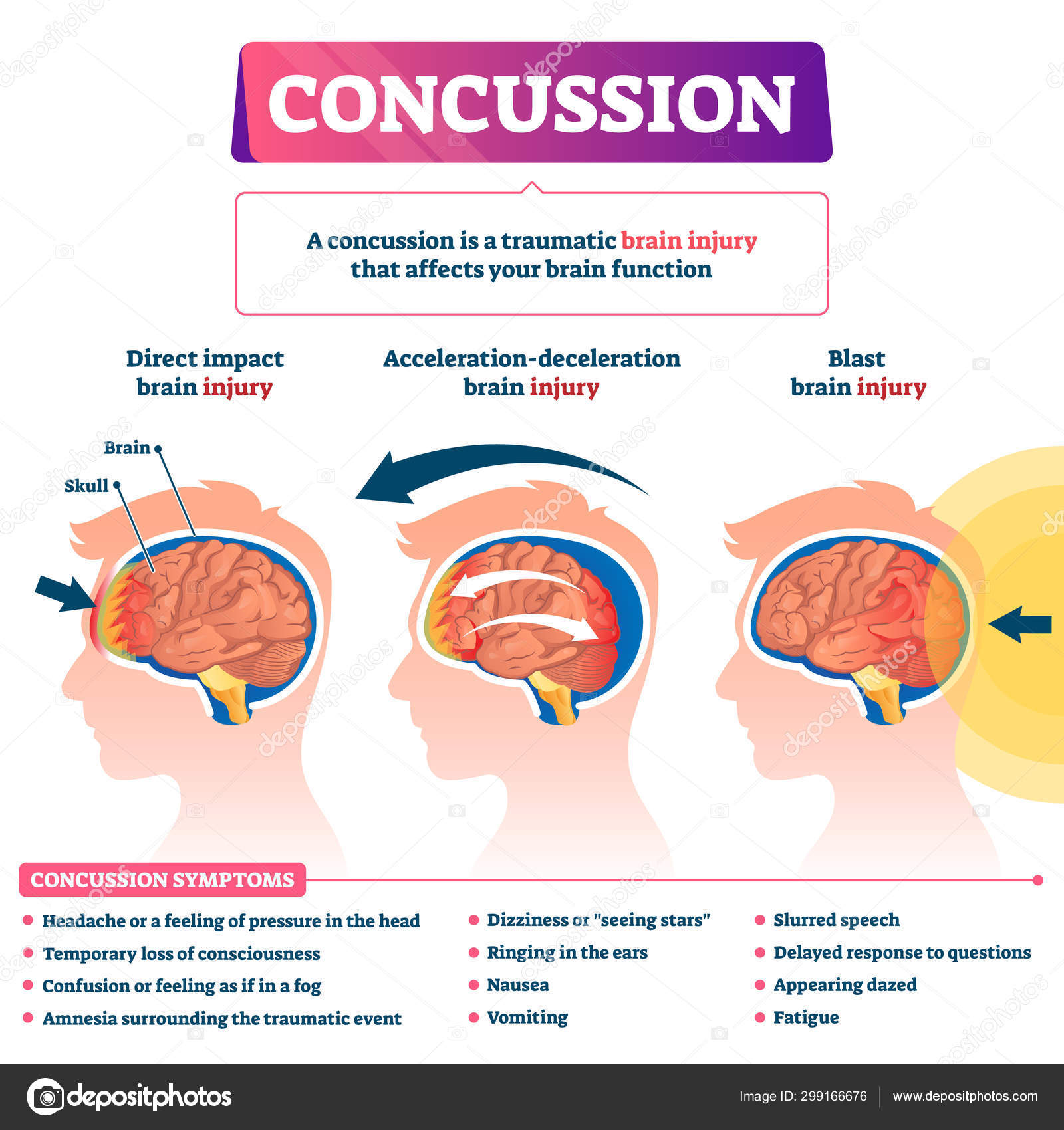 Illustration vectorielle de commotion. Labellisé post-traumatologie ...