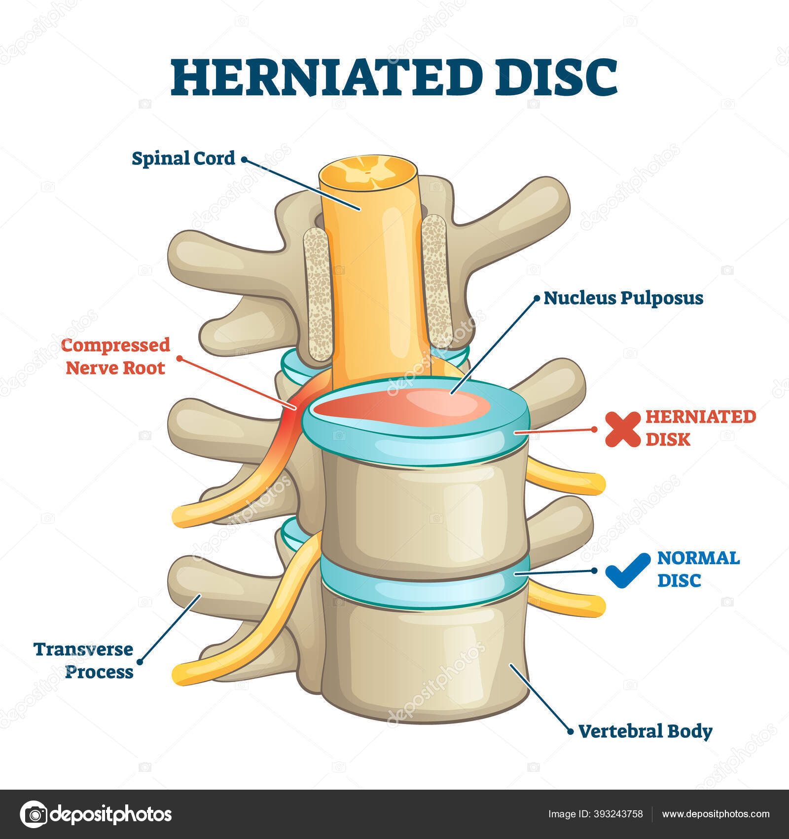 Herniated disc injury 3D side view on spine bone skeleton vector ...