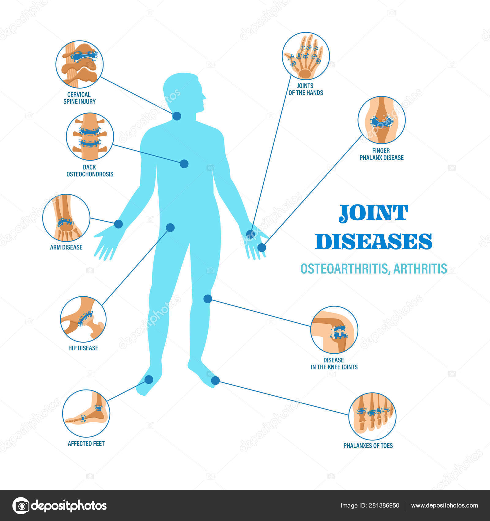 Joints diseases infographic banner vector illustration infographic ...